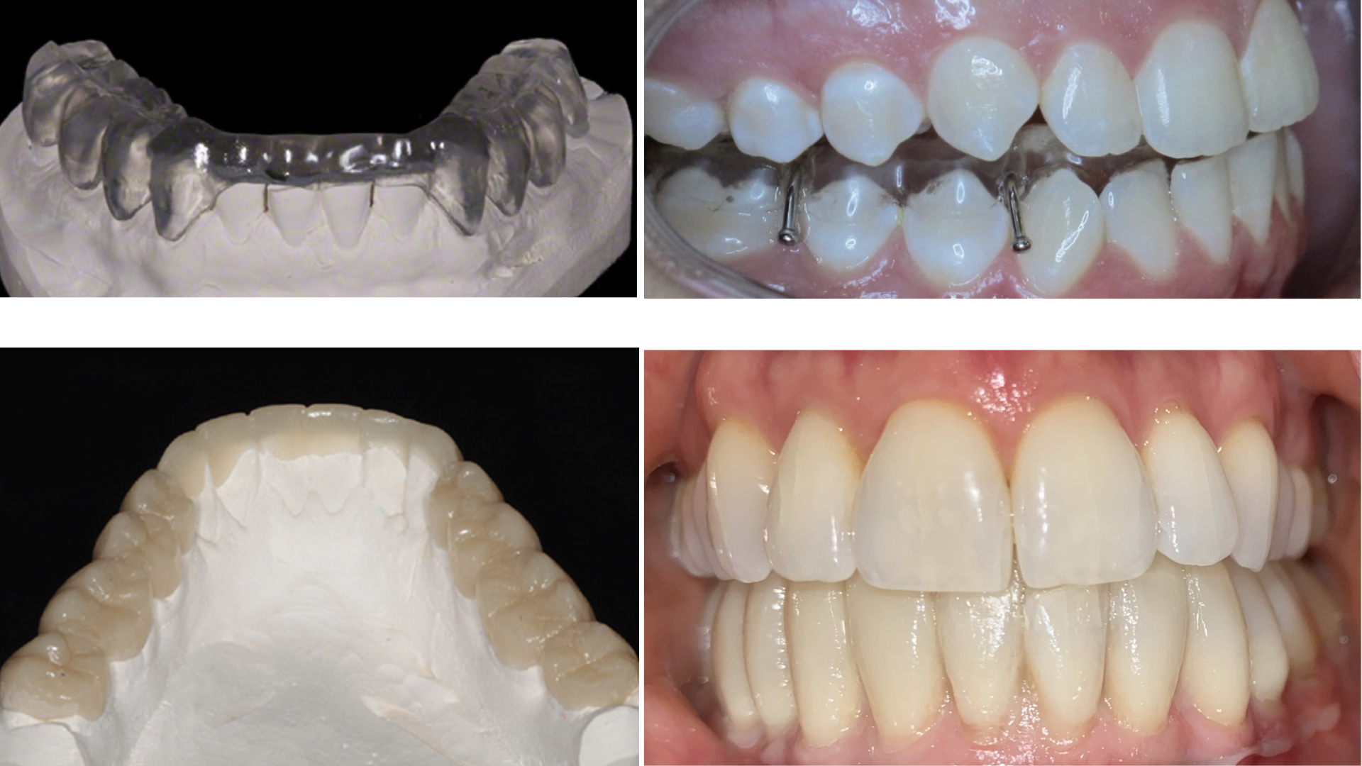 Temporomandibular Disorder (TMD) Treatment | Smiles by Bis