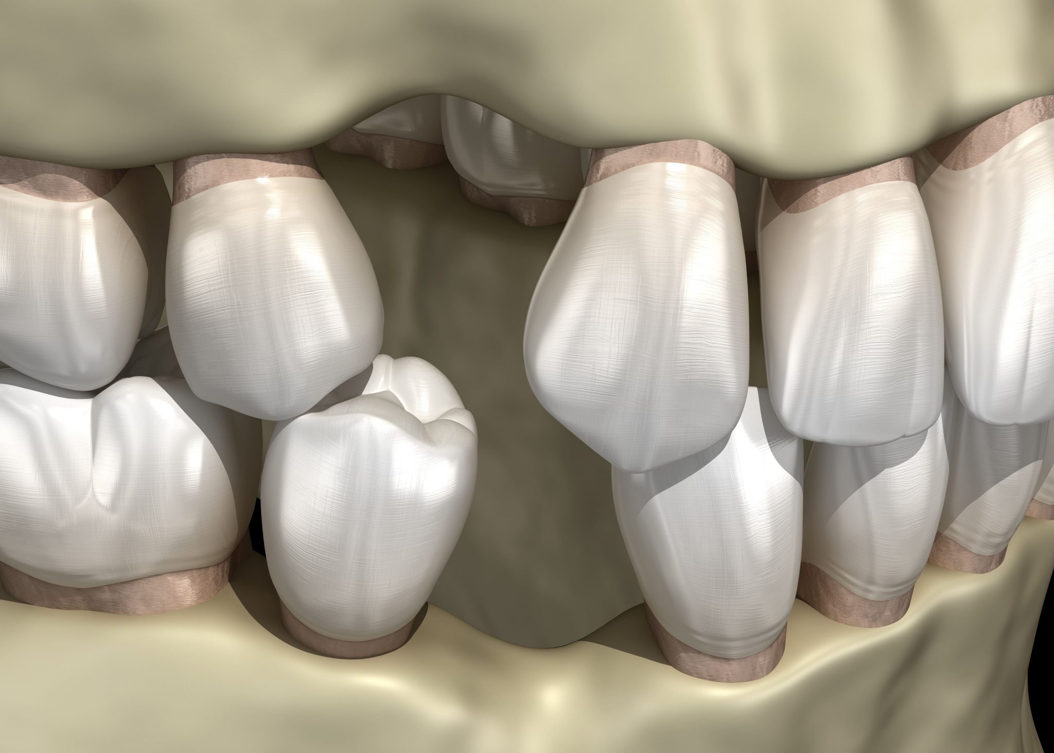 TMJ Disorder & Bone Loss - How occlusion impacts bone health | Smiles ...