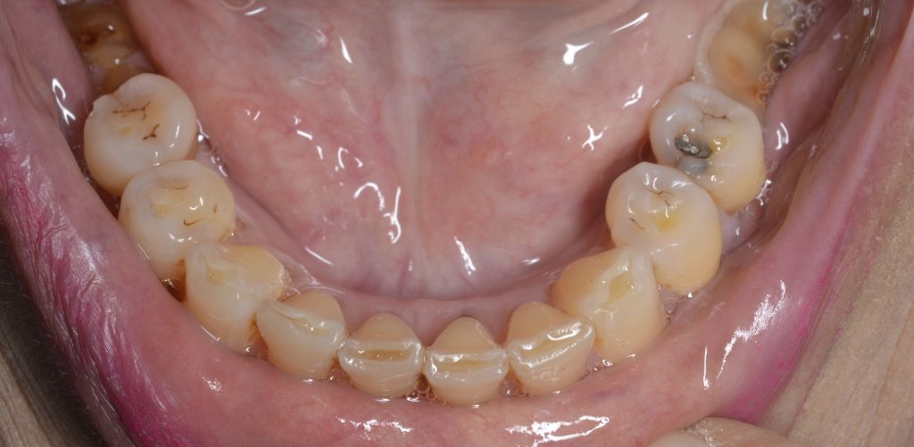 Fractured Molar Cusp or Broken Crown on Molar | Smiles By Bis