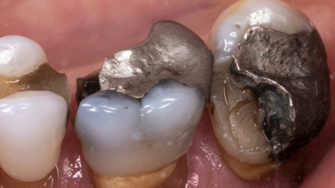 Dental Amalgam Mercury Filling Removal - The Amalgam Controversy | Dr ...