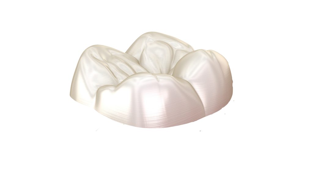 Porcelain Onlays | Smile By Bis