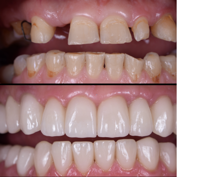 Replace Missing Teeth & Restore Your Smile | Smiles By Bis