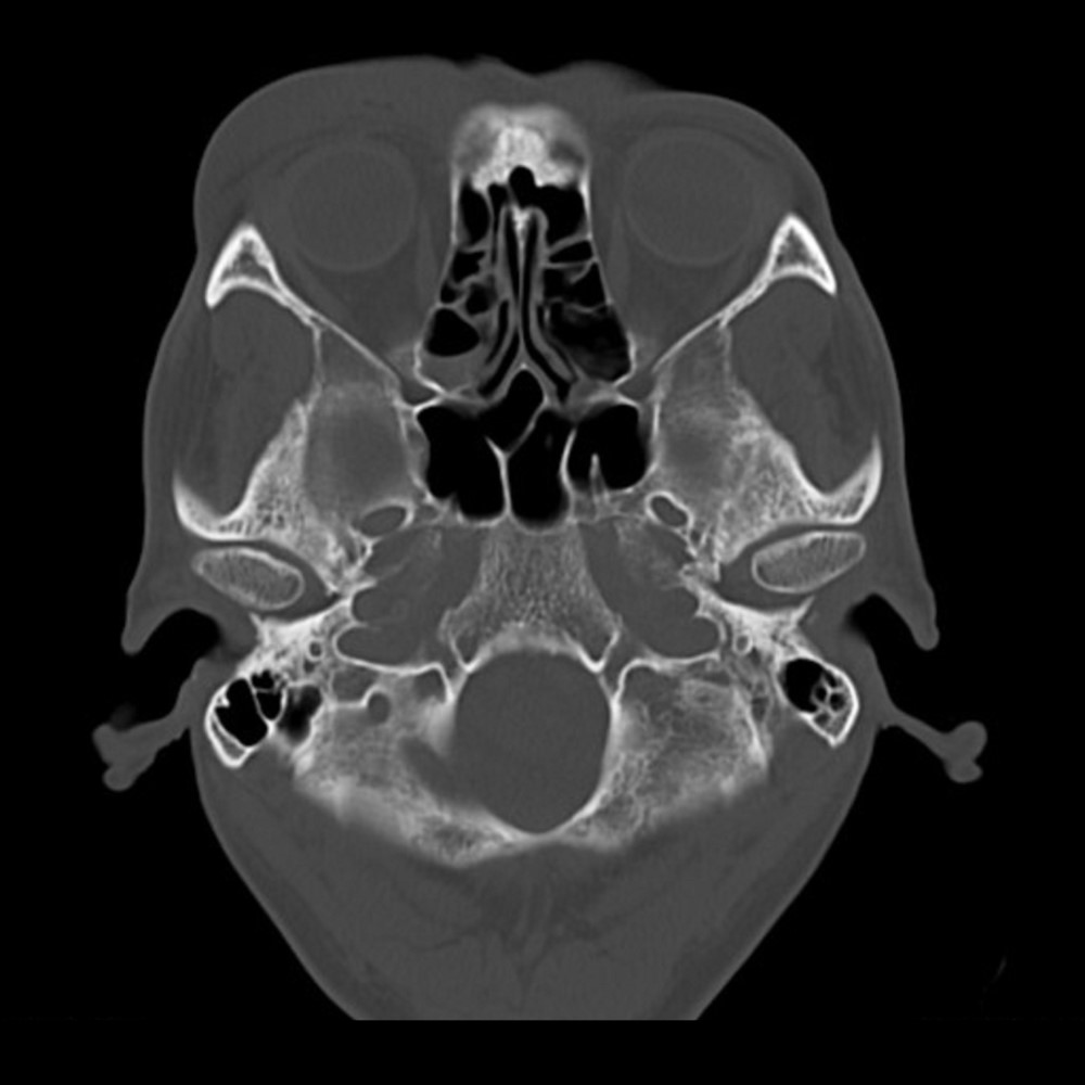 Advancing TMJ Treatment with Cutting Edge CBCT Imaging - Smiles By Bis